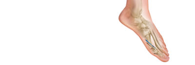 PROstep™ MIS | Stryker