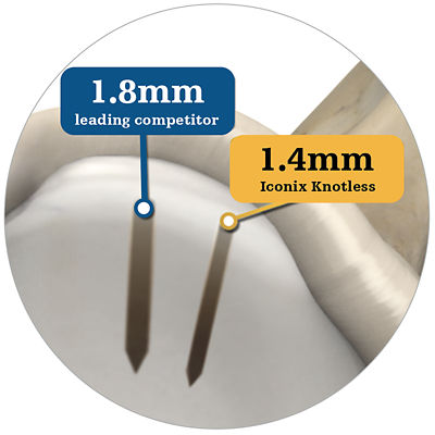 Iconix Knotless all-suture knotless anchor | Stryker